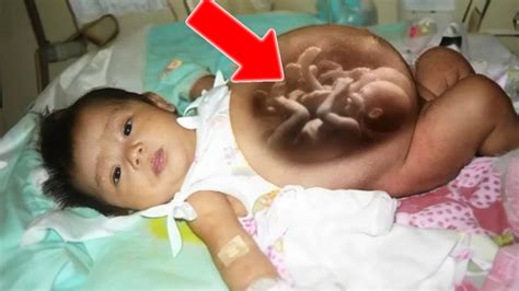 Doctors Thought She Had A Tumor In Her Abdomen But When She Was Born
