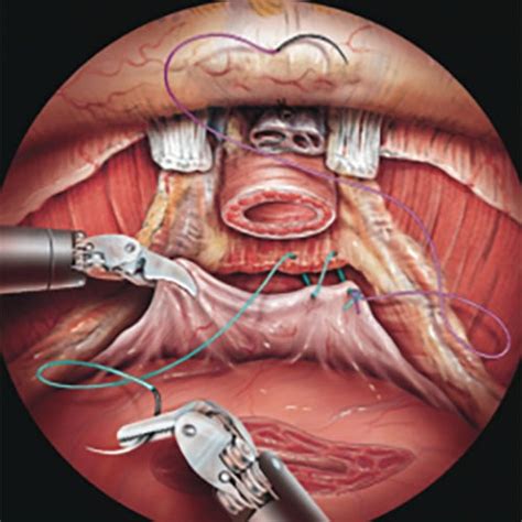 Robotic Prostatectomy Less Pain Faster Recovery—heres How