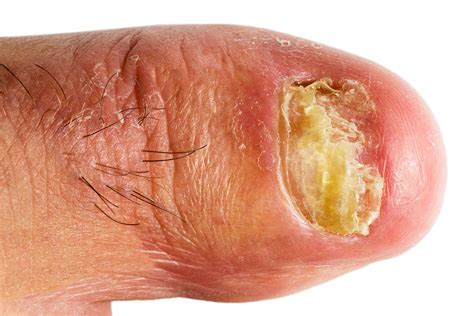 Rising Antifungal Resistance Poses A Threat To Onychomycosis Treatment