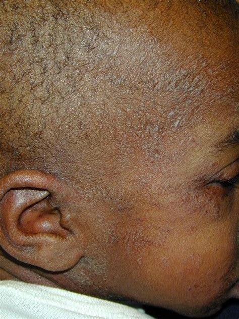 Poze Medicale Stafilococul Auriu Si Alte Infectii Stafilococice