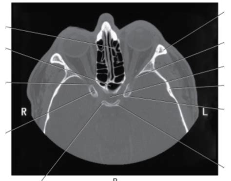 Fig 2 22 Axial Ct Of Anterior Clinoid Process Quiz