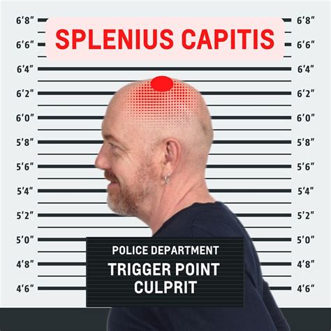 Put A Cap On Splenius Capitis Headaches