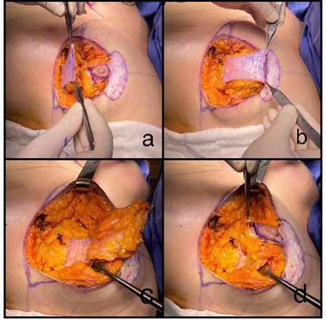 A Elevation Of The Lift Flap B Transposition Of The Lift Flap C