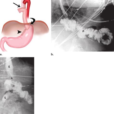 Pdf Esophagectomy And Gastric Pull Through Procedures Surgical Techniques Imaging Features