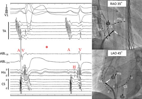 Electrograms From The Successful Ablation Site During Mapping Of The