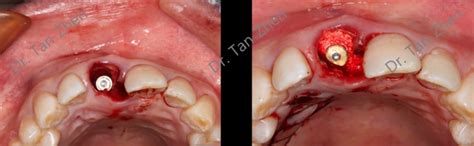早读 游离结缔组织移植一例 好医术文章 好医术 赋能医生守护生命