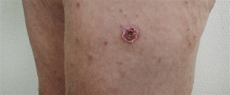 The Importance Of Early Detection And Treatment Of Eschar