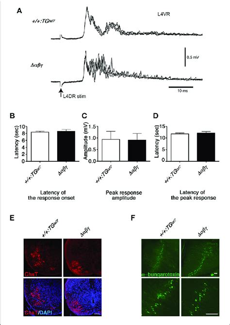 Normal Monosynaptic But Abnormal Polysynaptic Stretch Reflex
