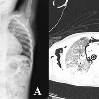 Chest X Ray A And CT B Showing Multiple And Bilateral Ground Glass Download Scientific