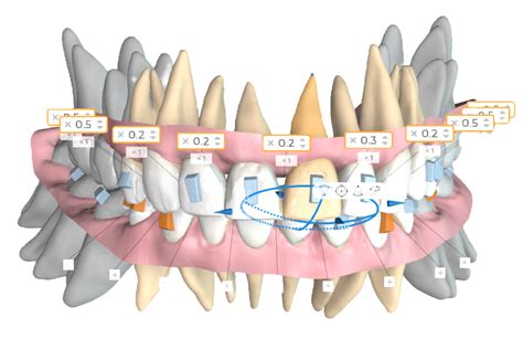 Considerations When Utilizing Ipr In Clear Aligner Treatments