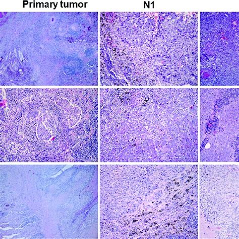 Heterogeneous Responses Of Rvt In Different Regional Lymph Nodes A