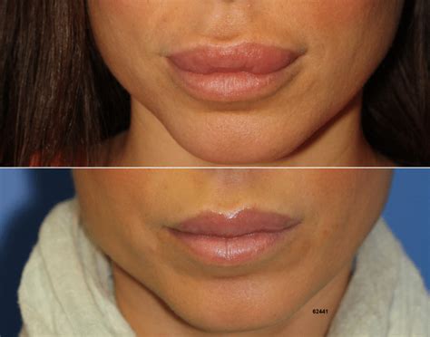 Lip Reduction Surgery Cost Insurance Recovery And Risks