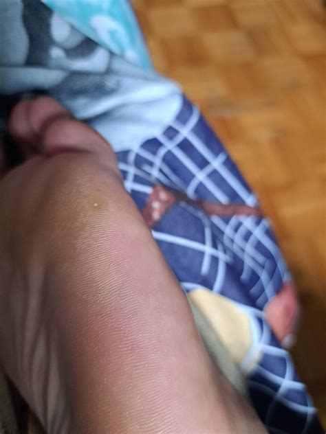 Should This Wart Be Treated It Is On My Husbands Upper Eyelid I Had