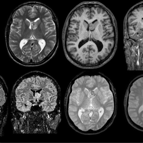 Retinal Achromic Patch Indicated By Arrow Download Scientific Diagram