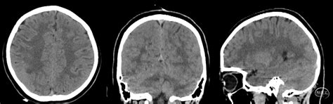 龚德山教授团队：顶叶难治性癫痫病例分享 脑医汇