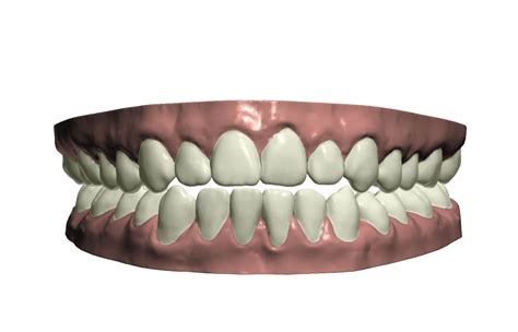 Open Bite Solutions Best Teeth Aligners Deutsche Aligners