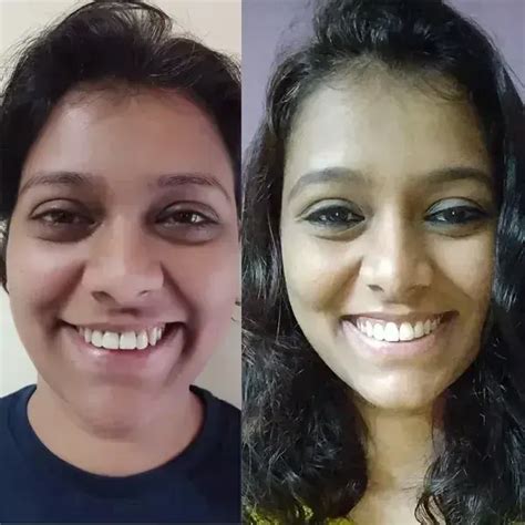 Forwardly Placed Teeth Heres How You Can Fix It