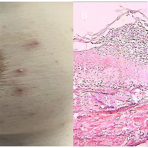 A Pustules On The Right Side Of The Chest B Histopathology On The