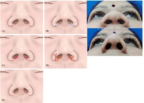 Alar Base Reduction A Guide To Nostril Reduction Surgery Pink Apple Aesthetics
