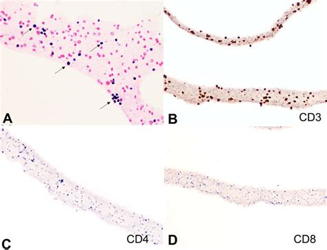 Cell Block Preparation From Csf Cytology And Limited Panel Of Download Scientific Diagram