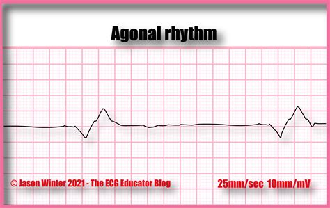 Ecg Educator Blog Agonal Rhythm
