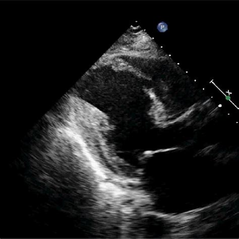 Tte Left Ventricular Long Axis View Shows The Interventricular Septum Download Scientific