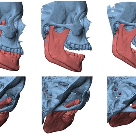 Surgical Sequence Of The Intraoral Coronoidectomy The Patient Shows An