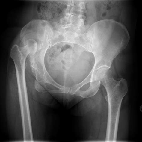 Case 19 Complex Primary Hip Replacement For Severe Crowe Grade 4 Hip