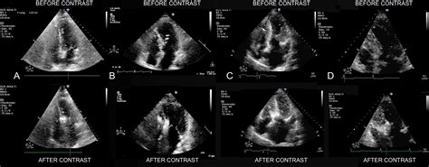 Bubble Contrast Echocardiography For Alcohol Septal Ablation Revista