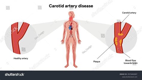 Carotid Artery Disease Signs Carotid Artery Stock Vector Royalty Free