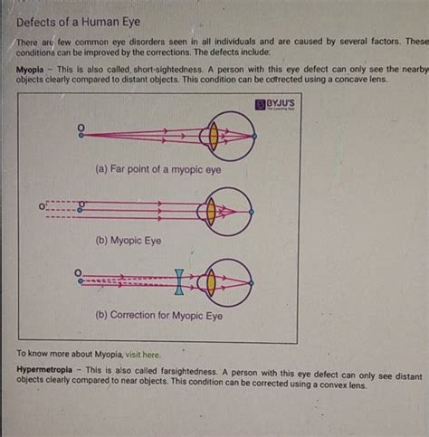 Defects Of A Human Eyethere Are Few Common Eye Disorders Seen In All Ind