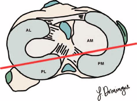 Updated Schatzker Classification Illustration By Lauren Domingue