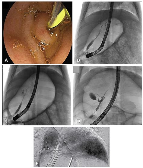 Endoscopic Mediated Biliary Hydrodynamic Injection Mediating Clinically Relevant Levels Of Gene