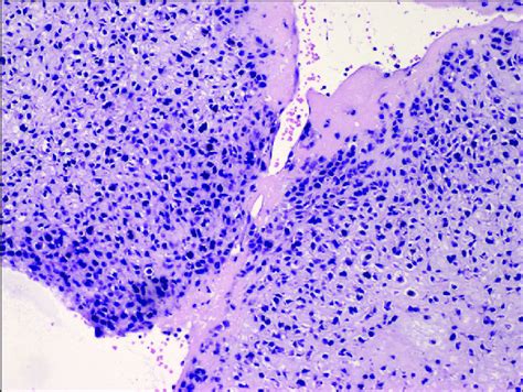 Subintimal Proliferation Of Cells In A Focally Myxoid Stroma H And E Download Scientific