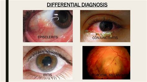 Episcleritis And Scleritis Causes Clinical Features Treatmentpptx