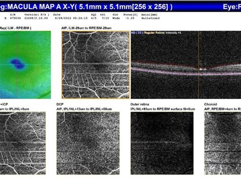 Hello Is This Petechiae In My Mouth From A Blood Disorder Raskdocs