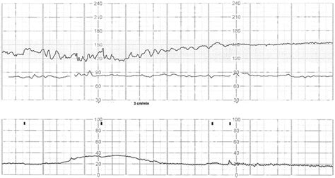 Electronic Fetal Monitoring Strip 1 Download Scientific Diagram