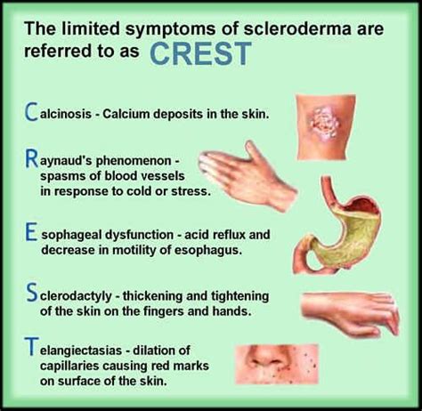 What Is Crest Disease Crest Syndrome Medlineplus Medical Encyclopedia