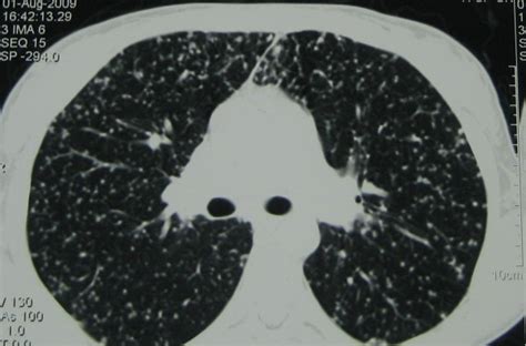 Ct Scan Shows The Typical Radiological Presentation Of Miliary Download Scientific Diagram