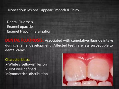 White Spot Lesions Pptx
