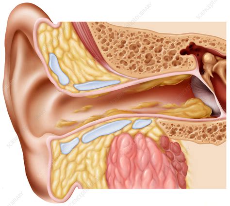 Earwax Stock Image P4300129 Science Photo Library