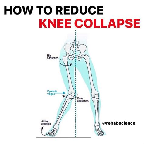 Dr Tom Walters Dpt On Instagram “💥𝐊𝐧𝐞𝐞 𝐕𝐚𝐥𝐠𝐮𝐬💥 ——— 🧠medial Valgus Knee Collapse I… Force