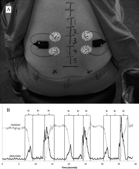 Illustration Of Emg Electrode Placement A And Example Emg And Motion
