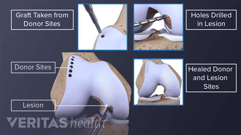 Knee Cartilage Repair Regeneration And Replacement
