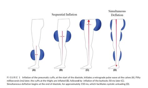 The Science Behind Eecp How Does It Improve Blood Flow