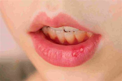 Mouth Cancer Vs Mouth Ulcer Identifying A Dangerous Lump