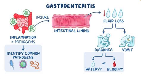 Infectious Gastroenteritis Clinical Sciences Osmosis Video Library