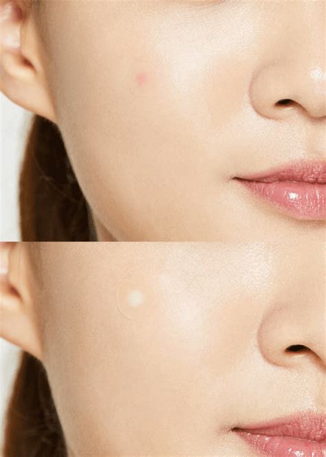 Cosrxacne Pimple Master Patch Glow Time