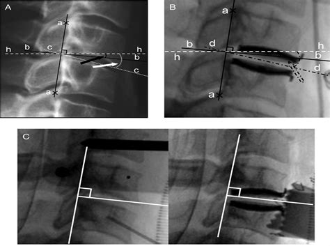 Segmental Malalignment With The Bryan Cervical Disc Prosthes
