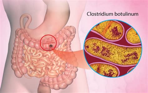 Botulism The Silent Threat Types Causes Symptoms And Treatment